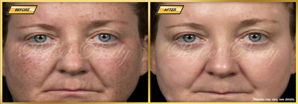 Color Correction & Skin Rejuvenation Long Island | Perfect Body Laser ...