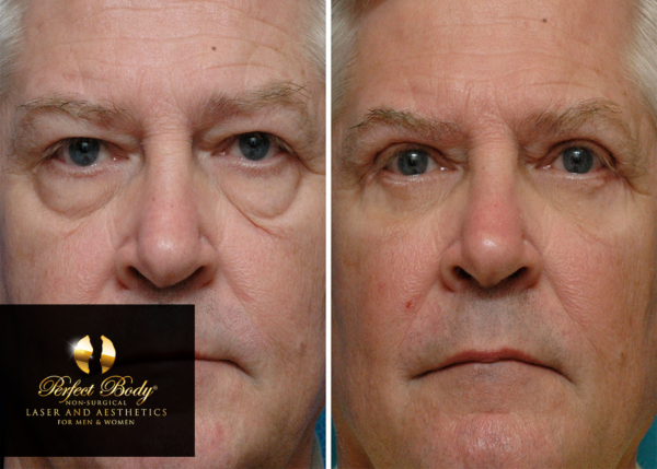 Ultherapy Laser Skin Tightening For The Face: Why It Works | Perfect ...