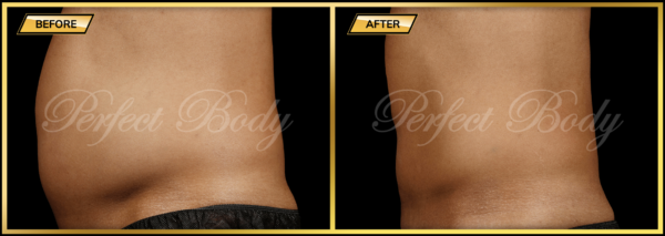 Body | Perfect Body Laser