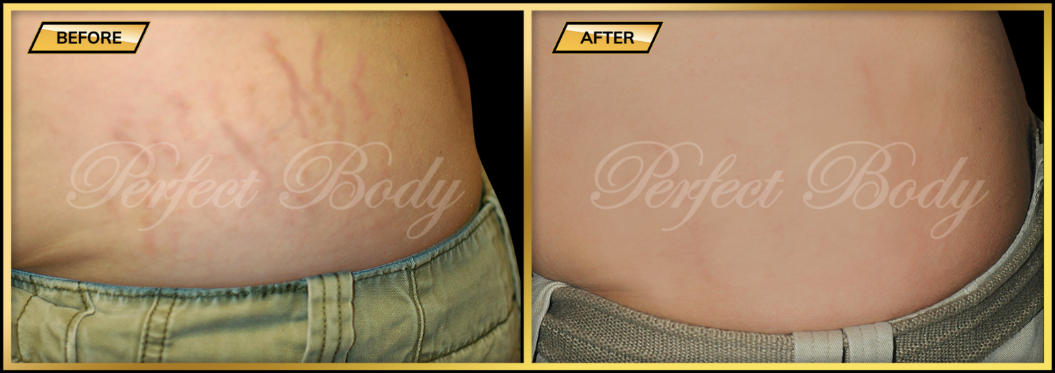 Skin | Perfect Body Laser