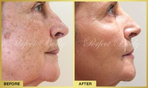 Color Correction & Skin Rejuvenation | Perfect Body Laser
