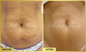 Fat Reduction Body | Perfect Body Laser